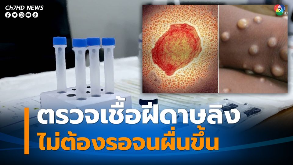 Dr. Anan suggested a throat swab to detect monkey pox infection. You ...